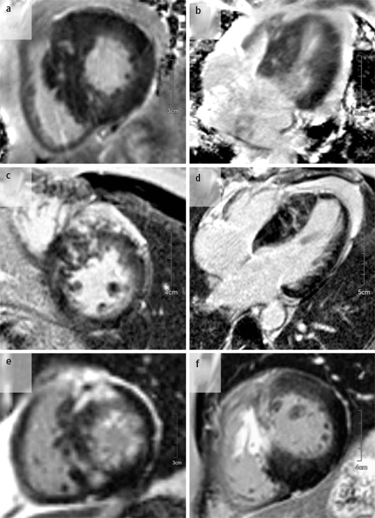 MRT-Bildgebung bei hypertropher Kardiomyopathie (HCM) | SpringerLink