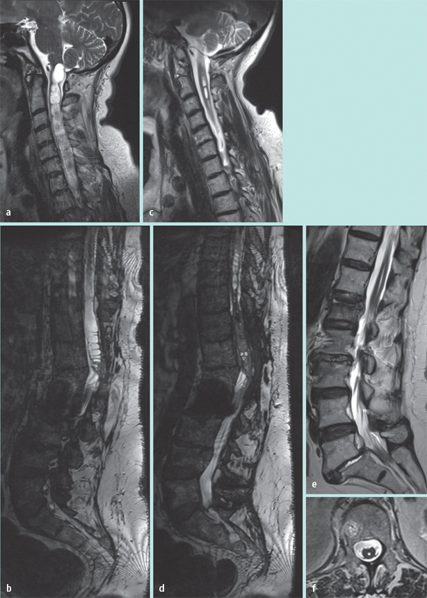 Rückenmarktrauma und Syringomyelie | SpringerLink