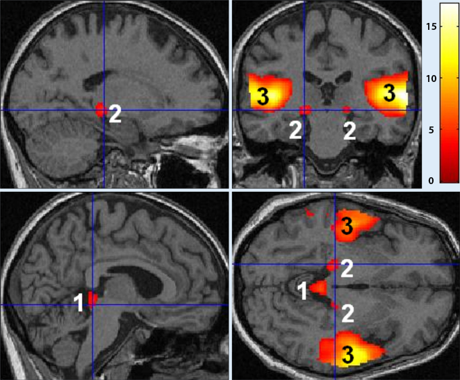 Funktionelle MRT des Hörzentrums | SpringerLink
