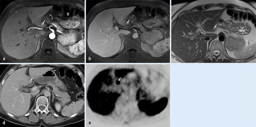 Gastroenteropankreatische endokrine Tumoren | SpringerLink