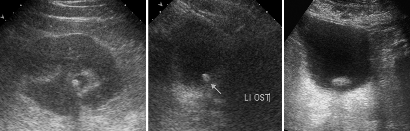 Bildgebungsmodalitäten und Therapieoptionen bei Patienten mit akutem ...