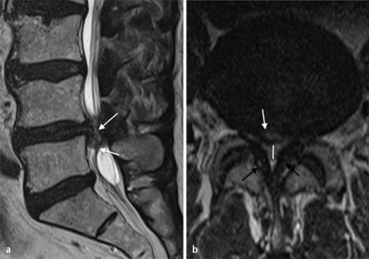 Spinalkanalstenose | SpringerLink