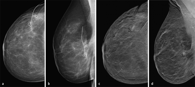 Digitale Tomosynthese der Mamma | SpringerLink