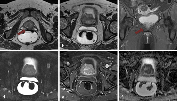 Onkologische Erkrankungen und postoperative Veränderungen der Harnblase ...