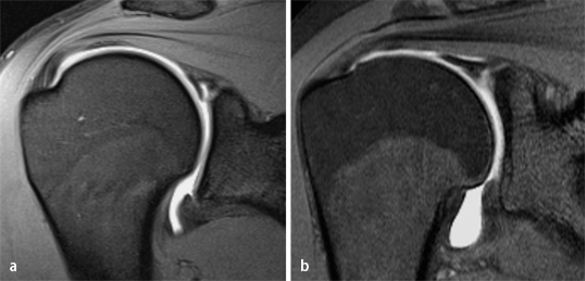 Klassifikation von Normvarianten des Labrums und Labrumverletzungen ...