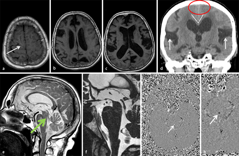 Normaldruckhydrozephalus | SpringerLink