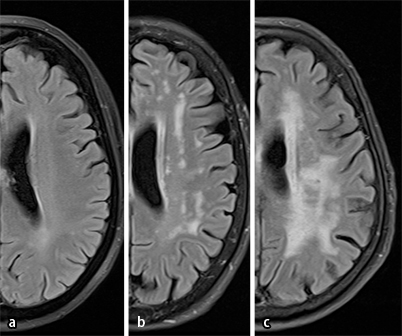 MRT bei demenziellen Erkrankungen | SpringerLink
