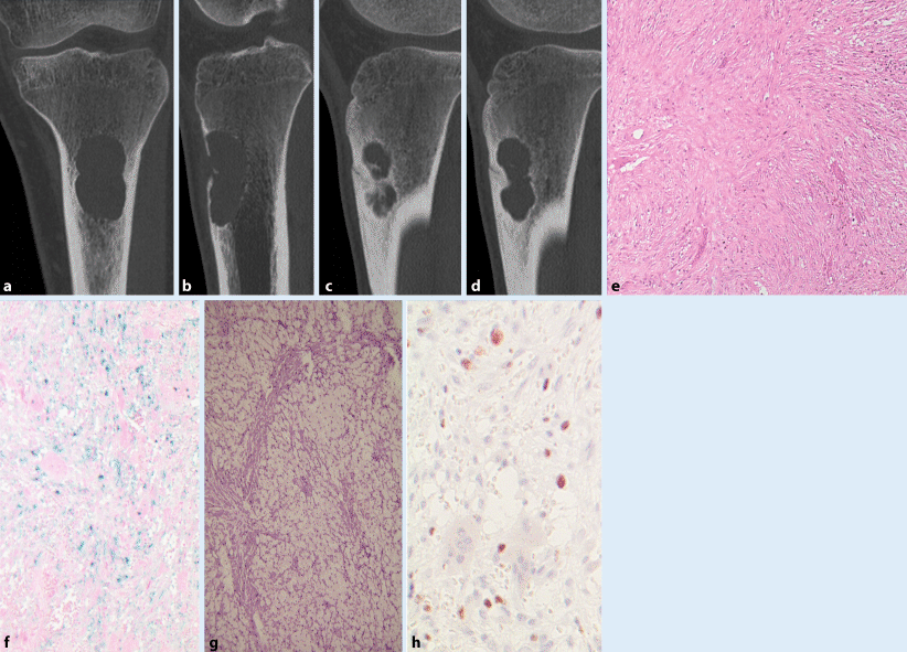 Ewing-Sarkom, fibrogene Tumoren, Riesenzelltumor, Hämangiom des ...