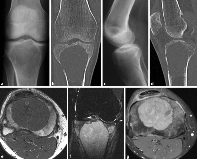 Ewing-Sarkom, fibrogene Tumoren, Riesenzelltumor, Hämangiom des ...