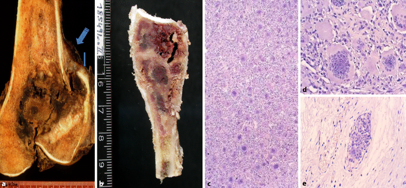 Ewing-Sarkom, fibrogene Tumoren, Riesenzelltumor, Hämangiom des ...