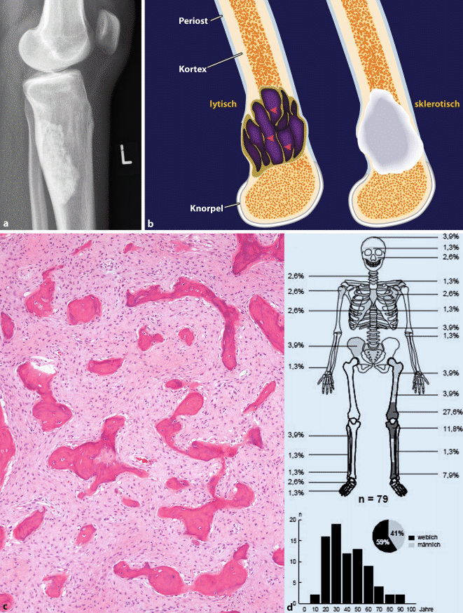 Osteogene Tumoren | SpringerLink