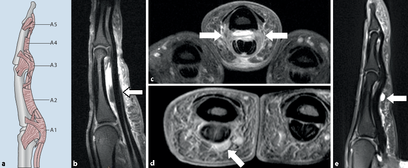 Bandverletzungen am Daumen und an den Fingern | SpringerLink