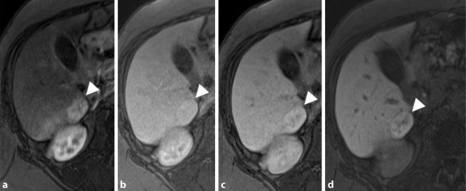 CT und MRT der Leber: wann, was, warum? | SpringerLink