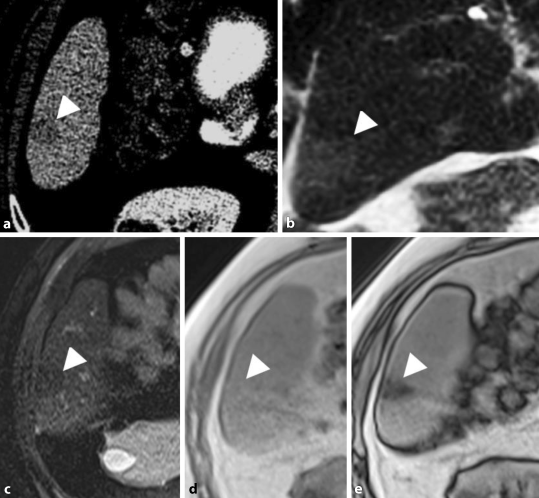 CT und MRT der Leber: wann, was, warum? | SpringerLink