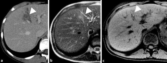 CT und MRT der Leber: wann, was, warum? | SpringerLink