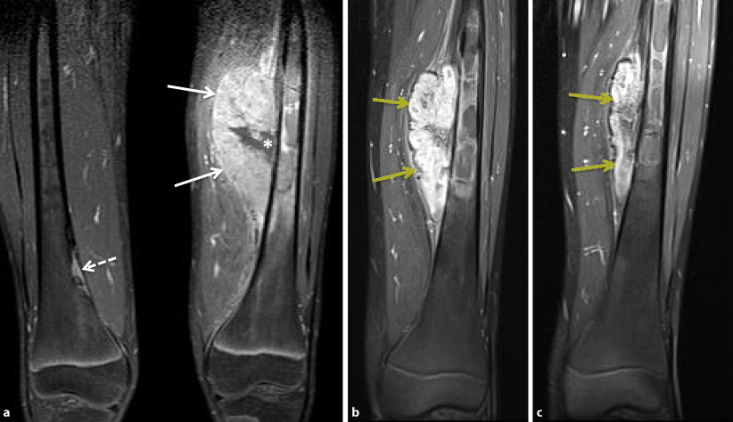 Postoperative und posttherapeutische Veränderungen nach primären ...
