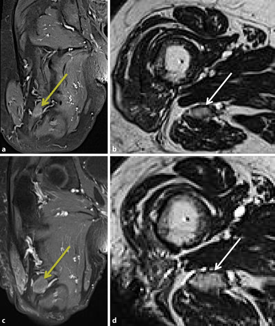 Postoperative und posttherapeutische Veränderungen nach primären ...