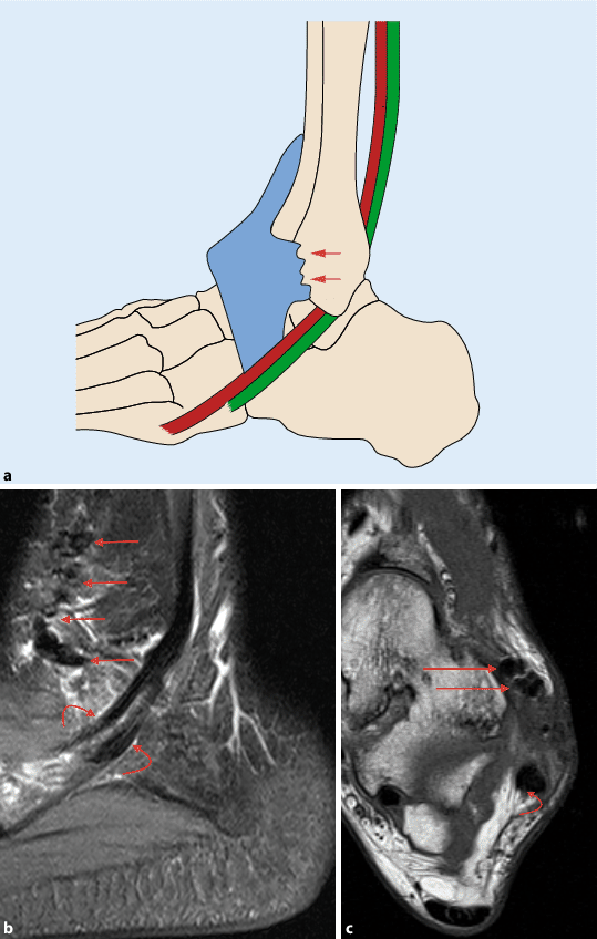 Postoperative Magnetresonanztomographie des Sprunggelenks | SpringerLink
