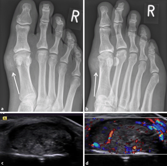 Entzündungen des Fußes | SpringerLink