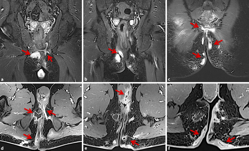 Perianale entzündliche Erkrankungen | SpringerLink