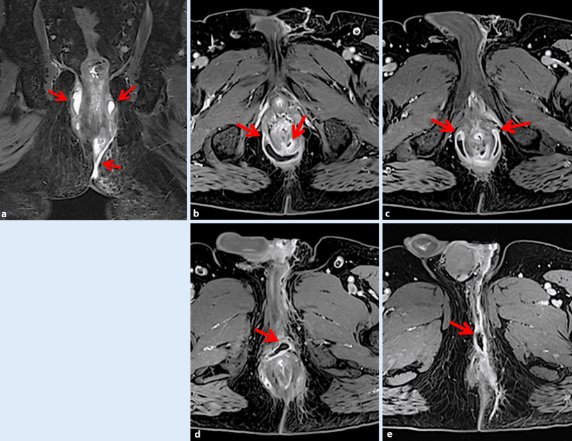 Perianale entzündliche Erkrankungen | SpringerLink
