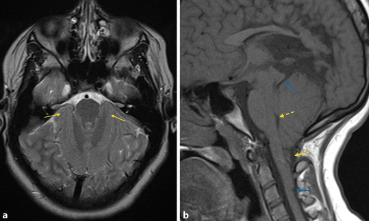 Chiari-Malformation | SpringerLink