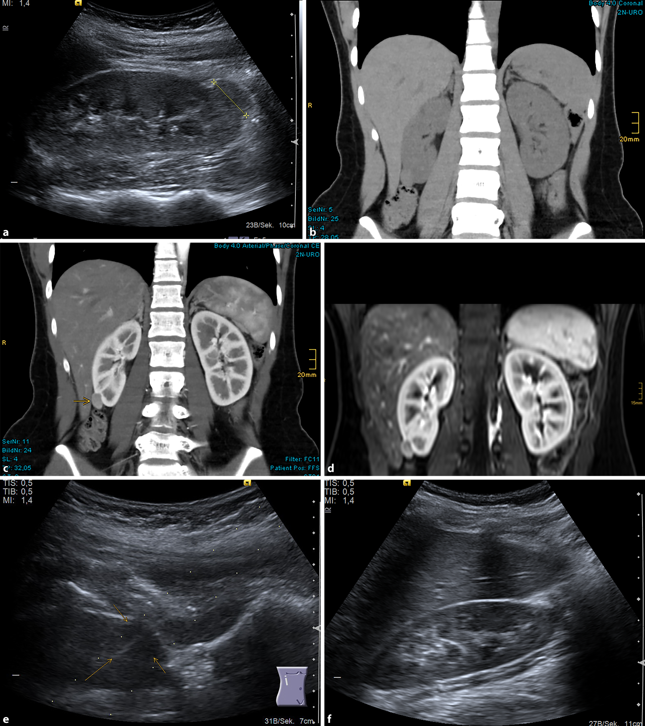 Biopsien von Nierenläsionen: wann und wie? | SpringerLink