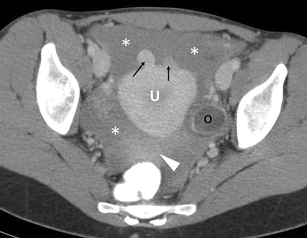 Akutes Abdomen der Frau: gynäkologische Ursachen | SpringerLink