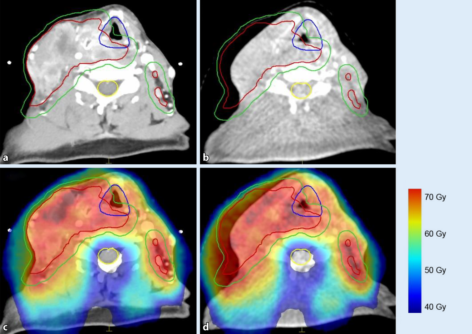 Image guidance: past and future of radiotherapy | SpringerLink