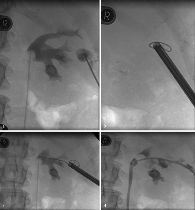 Minimal-invasive PCNL (Mini-Perc) | SpringerLink