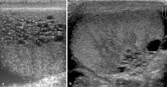 Tubuläre Ektasie des Rete testis | SpringerLink