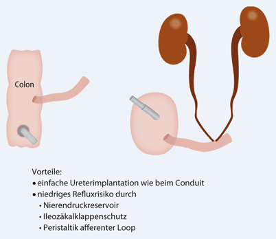 Harnableitung mit kontinentem Nabelstoma | SpringerLink