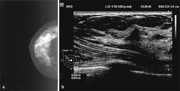Mammasonographie | SpringerLink