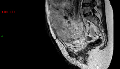 Placenta praevia marginalis increta | SpringerLink