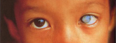 Vitamin-A-Mangel – ein potenziell übersehenes Problem | SpringerLink