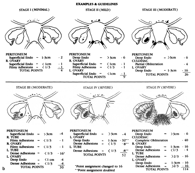 Klassifikation der Endometriose | SpringerLink