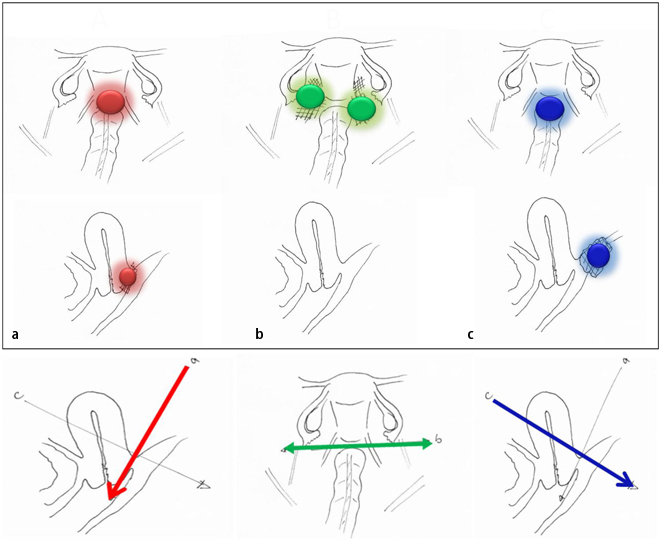 Klassifikation der Endometriose | SpringerLink