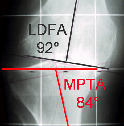 Die minimal-invasive Mini-Midvastus-Incision-Technik als Standard in ...