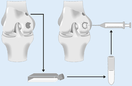 Autologe Chondrozytentransplantation | SpringerLink