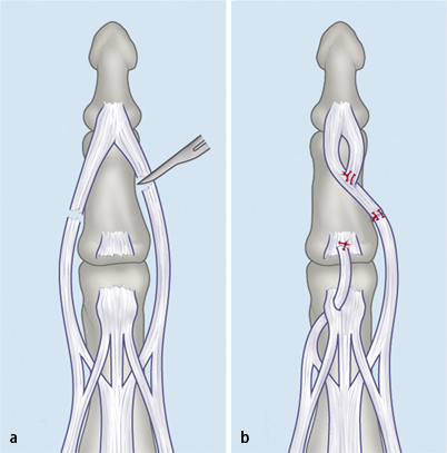 Die traumatische Knopflochdeformität | SpringerLink