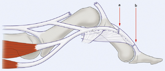 Die traumatische Knopflochdeformität | SpringerLink