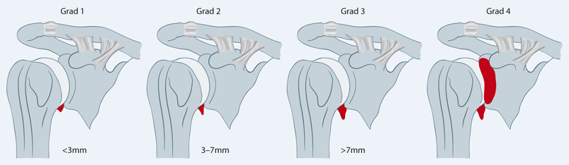 Instabilitätsarthropathie | SpringerLink