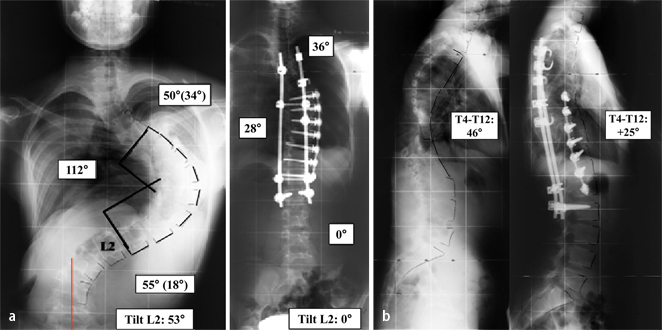 Ventrale Skolioseoperationen | SpringerLink