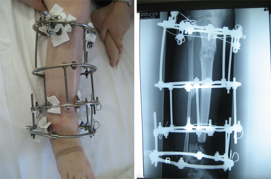 Fixateur-externe-Osteosynthese | SpringerLink