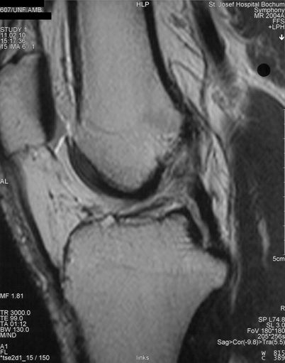 Ruptur des vorderen Kreuzbands | SpringerLink