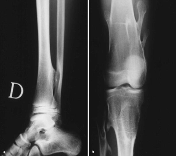 Gutartige Knochentumoren | SpringerLink