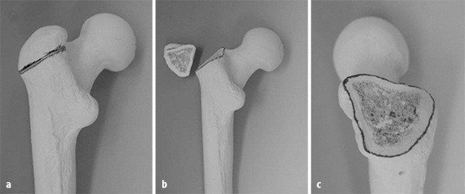 Osteotomien des Trochanter major | SpringerLink