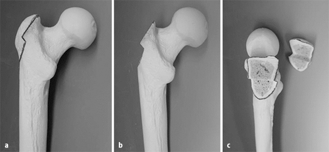 Osteotomien des Trochanter major | SpringerLink