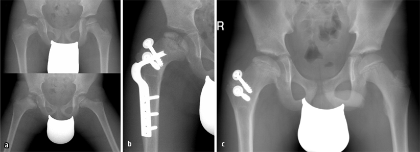 Aktuelle Behandlungsstrategie des Morbus Perthes | SpringerLink