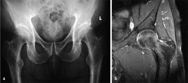 Das Knochenmarködemsyndrom (KMÖS) | SpringerLink